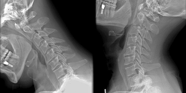 Cervical Spine Surgery in Plano TX - Minimally Invasive Neurosurgery of ...