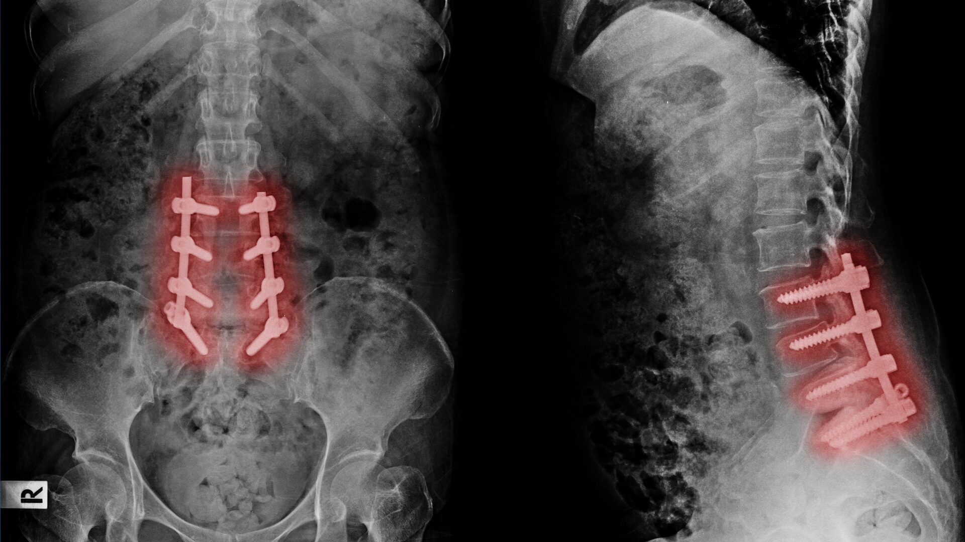 Disc Decompression Surgery in Plano TX - MINSTX.COM