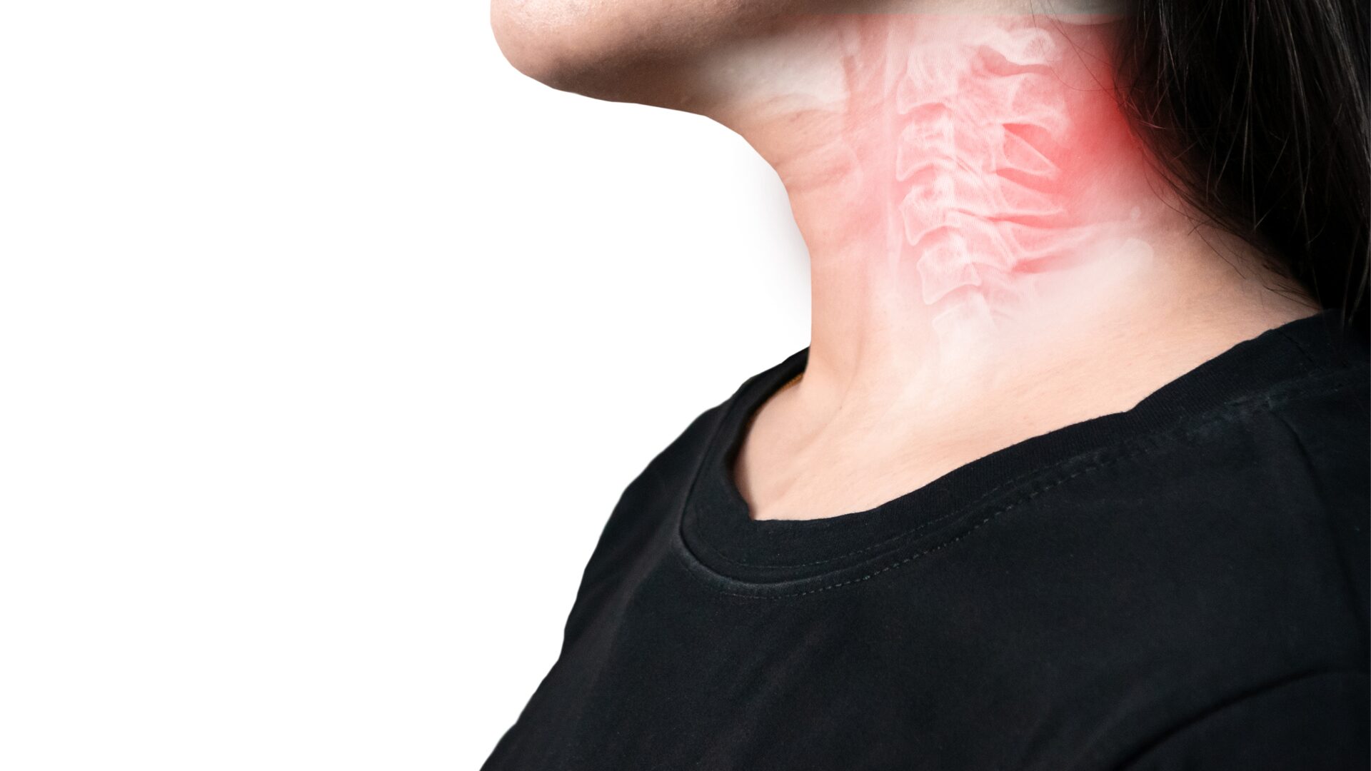 Cervical Radiculopathy Treatment Allen TX